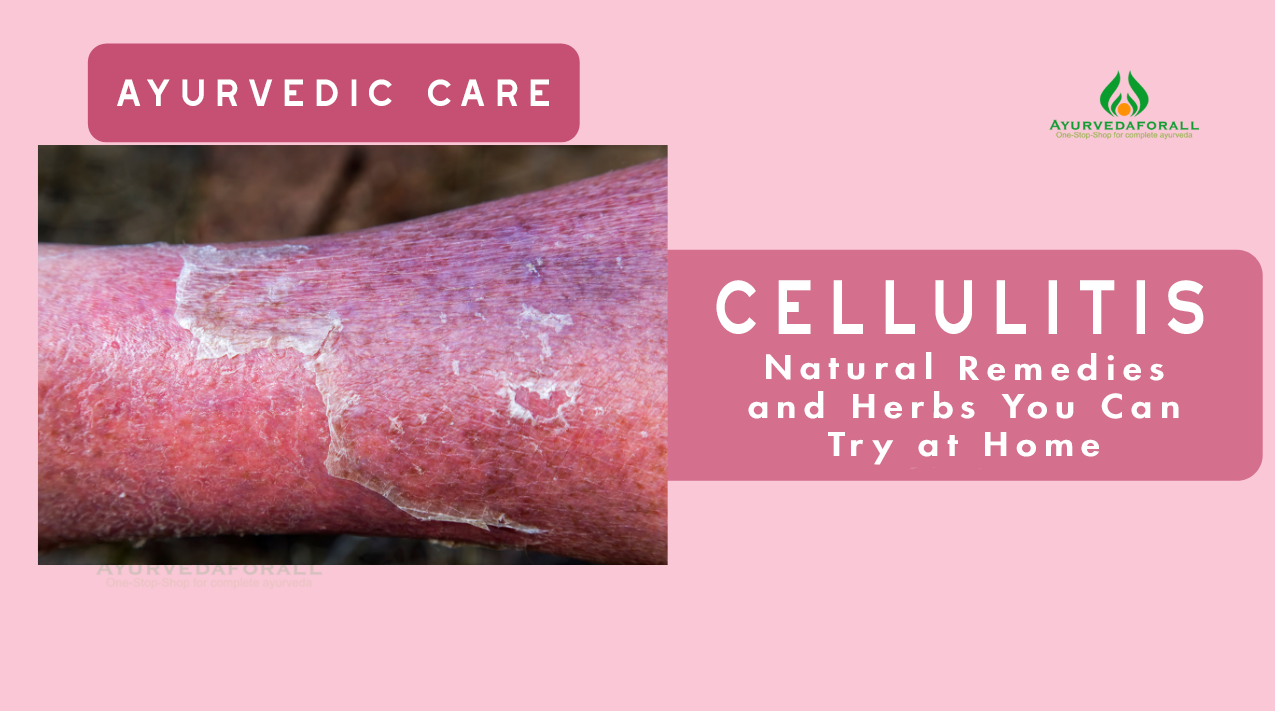 9 Natural Remedies for Cellulitis (And Herbs You Can Try At Home!)
